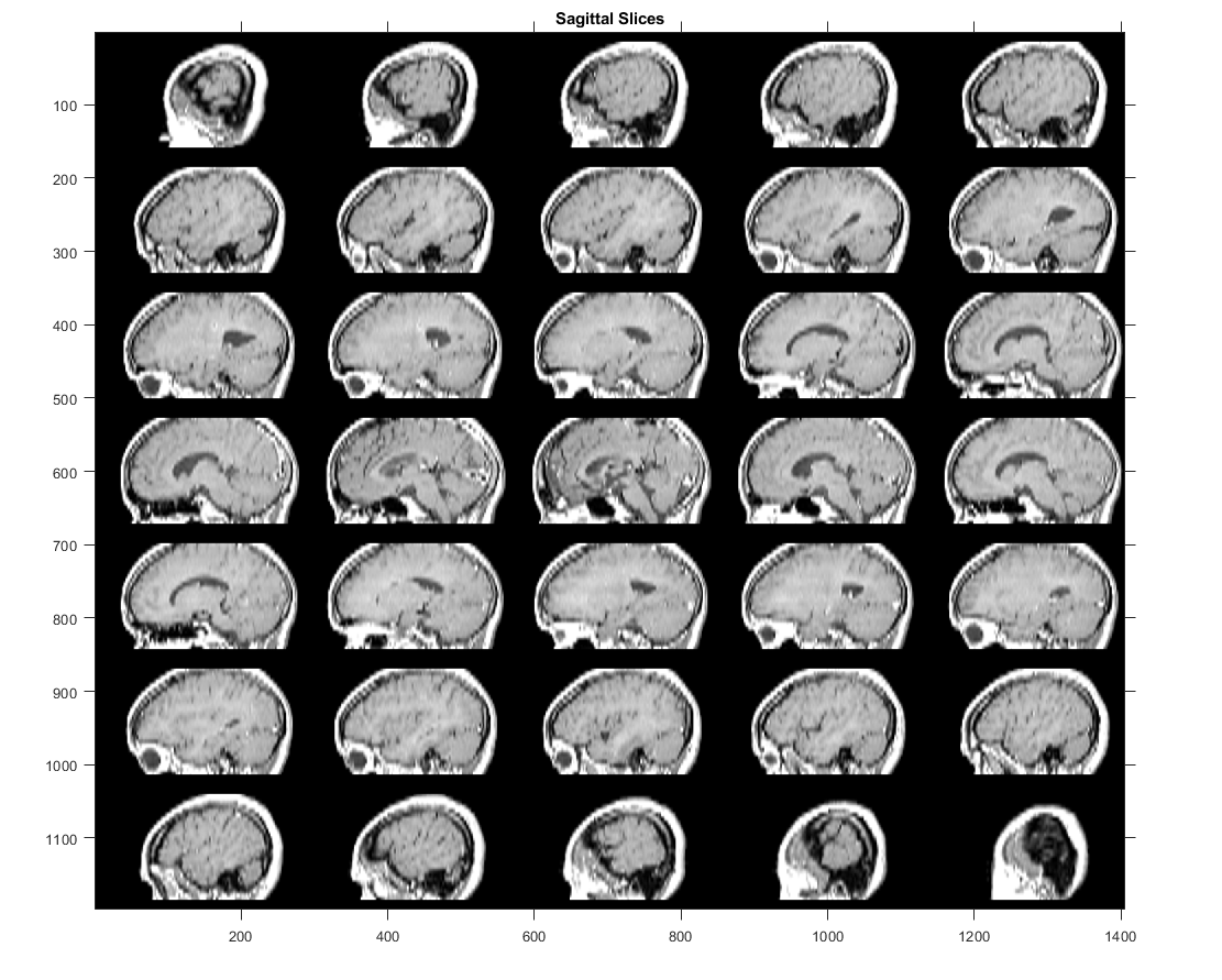 Musicians with absolute (perfect) pitch have a 'pruned' planum ...