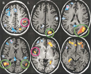 Music is processed in 'visual areas' of a blind musician's brain ...