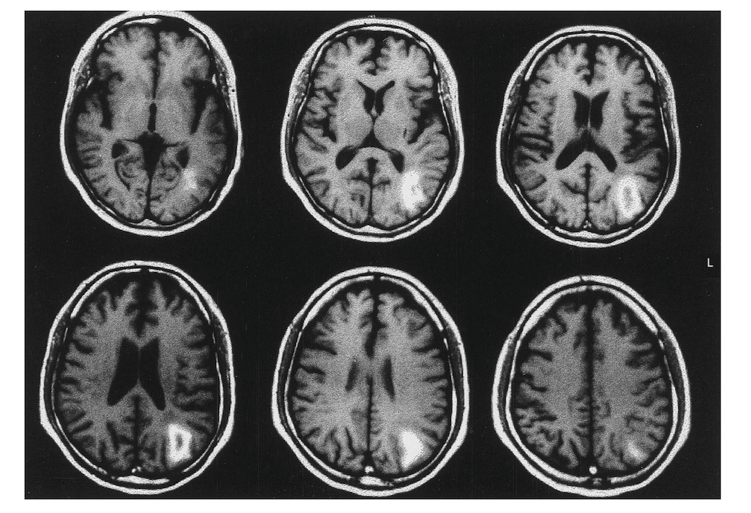 Stroke affects a trombonist’s ability to read and write music - ADRIAN ...
